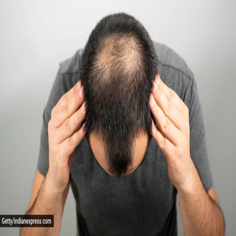 What is the best effective treatment for hair loss? - Fedelty Healthcare